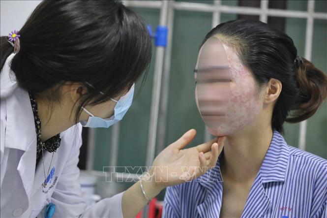 Cô gái mặt bỏng rát, sưng vù và đầy mụn mủ sau khi làm đẹp tại một spa ...