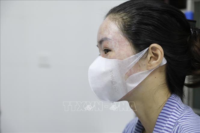 Cô gái mặt bỏng rát, sưng vù và đầy mụn mủ sau khi làm đẹp tại một spa ...